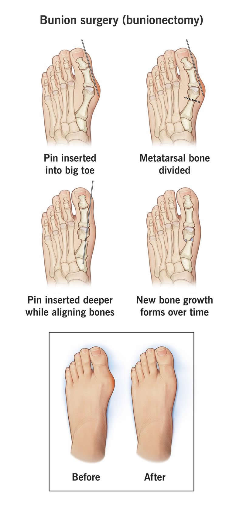 Bunion Surgery (Bunionectomy): Types & Recovery Time - Wockr