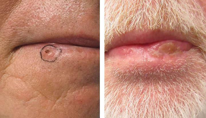 Lip Cancer: Symptoms, Stages & Treatment - Wockr