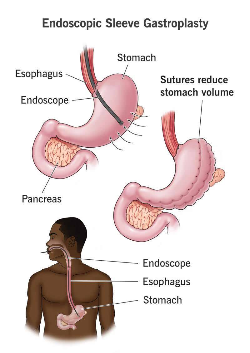 Endoscopic Sleeve Gastroplasty - Wockr