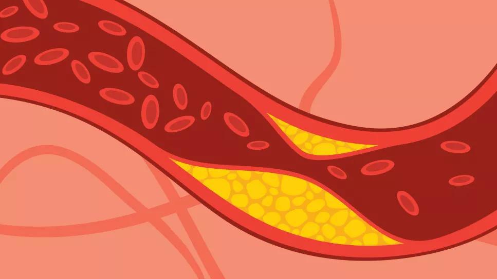 What Sticky Cholesterol Means for Your Heart - Wockr