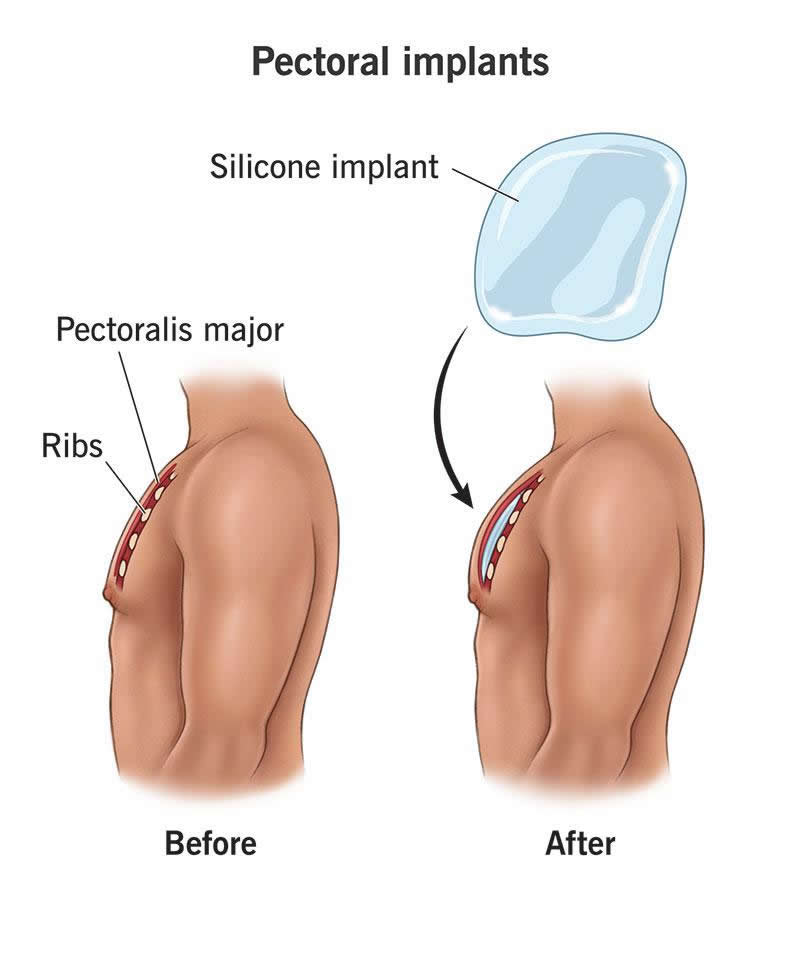 Pec (Pectoral) Implants: Surgery, Scars, Before & After - Wockr