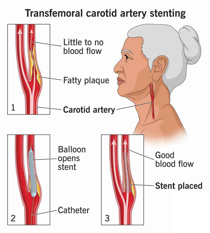 Transfemoral Carotid Artery Stenting: Procedure & Outlook - Wockr