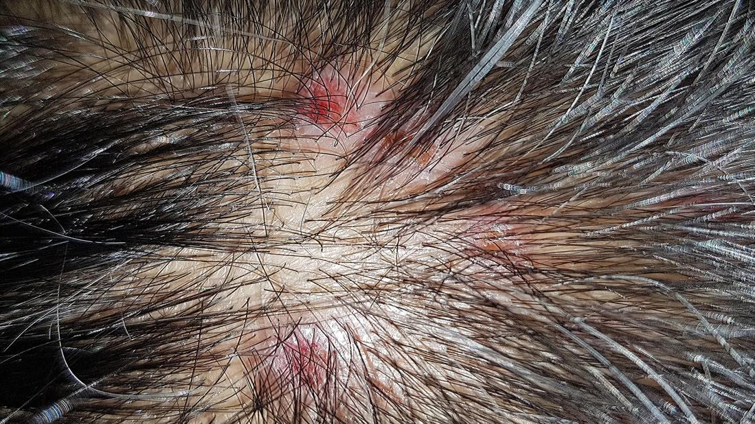 Scabs on Scalp? Why You Have Them and How To Treat - Wockr